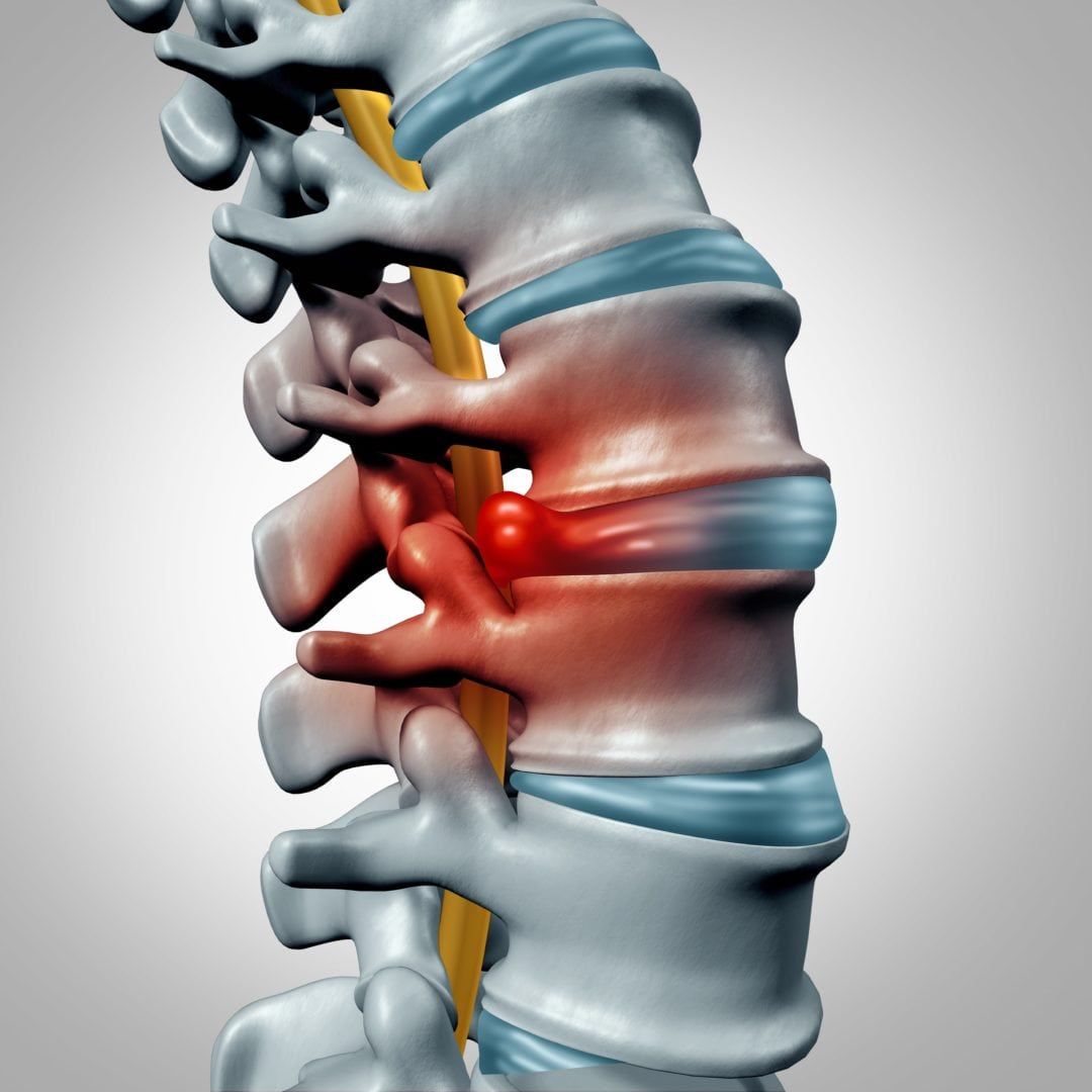 Bone Spurs, Bulging Discs, & Pinched Nerves--What Do These Mean To You