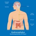 How Does a VP (Ventriculoperitoneal) Shunt Work » Fort Worth ...