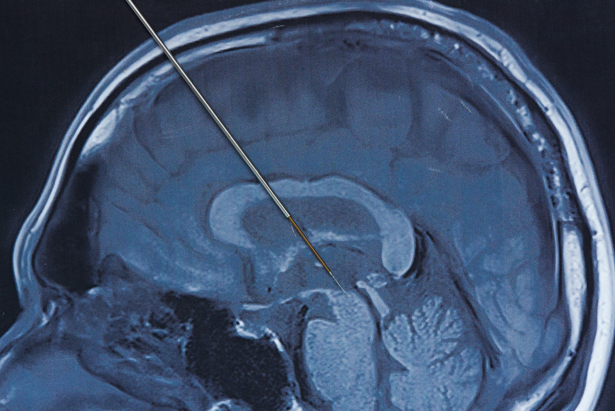 Deep Brain Stimulation for Parkinson’s » Fort Worth Neurosurgeon - Dr ...